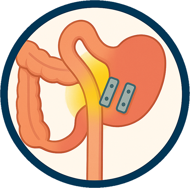 MagDI: Tecnología revolucionaria en cirugía bariátrica - Bariátrica
